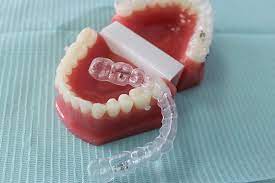 Cleaning Invisalign at Home: A Step-by-Step Guide