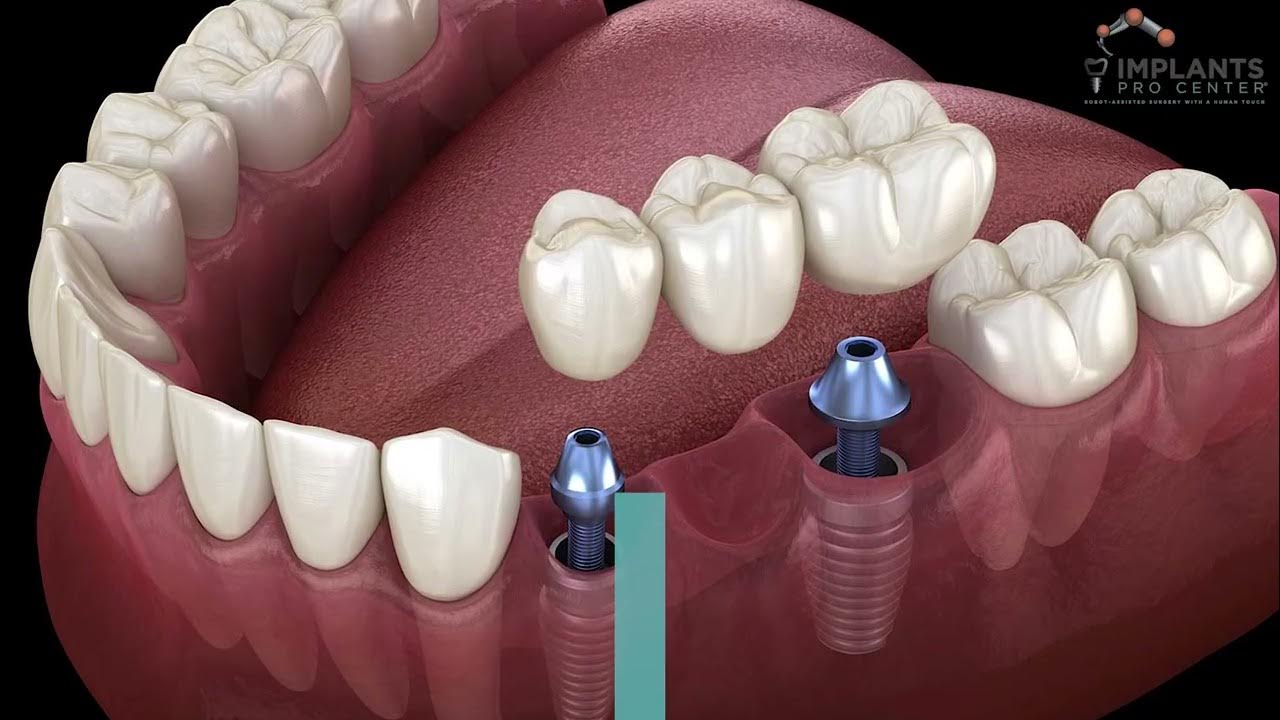 Moveable vs. Fixed Dentures: Choosing the Better Option