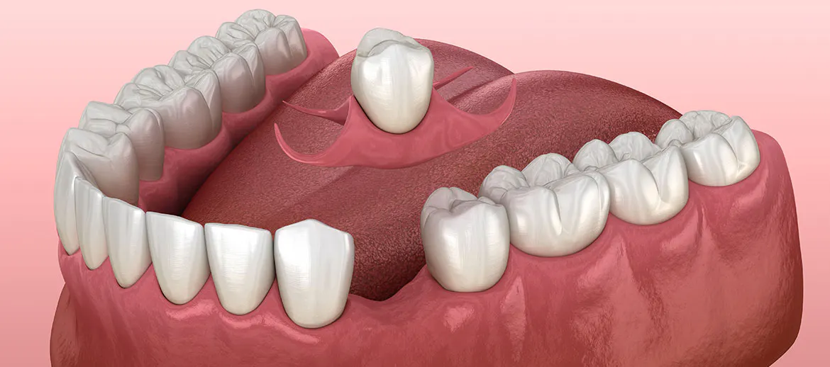 Removable Flippers: A Viable Option for Missing Teeth